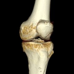 Tibia - DocCheck Flexikon