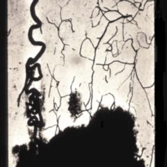 Vascular-loop-Syndrom - DocCheck Flexikon