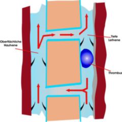 Thrombose - DocCheck Flexikon