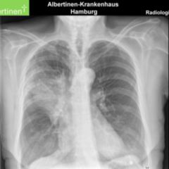 Kurvilineare Verdichtung - DocCheck Flexikon