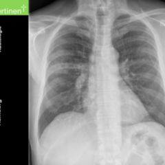Lungenlappen - DocCheck Flexikon