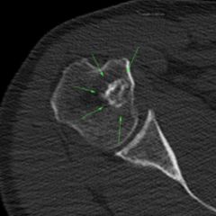 Osteochondrom - DocCheck Flexikon