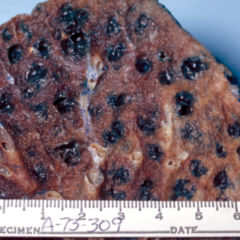 Emphysem - DocCheck Flexikon