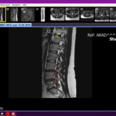 Bandscheibenvorfall - DocCheck Flexikon