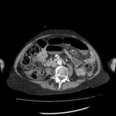 Stenose - DocCheck Flexikon
