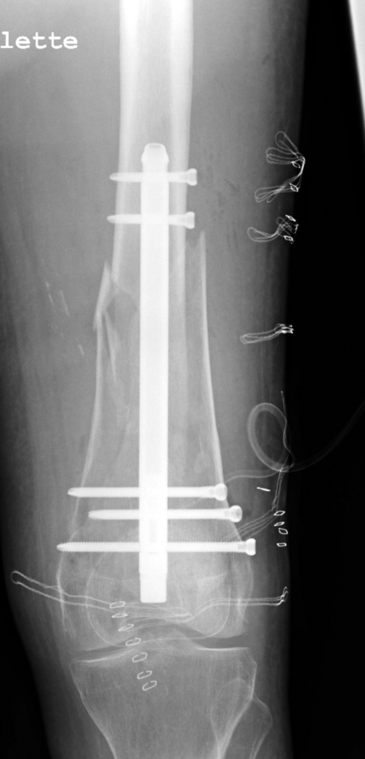 Retrograder Femurnagel - DocCheck
