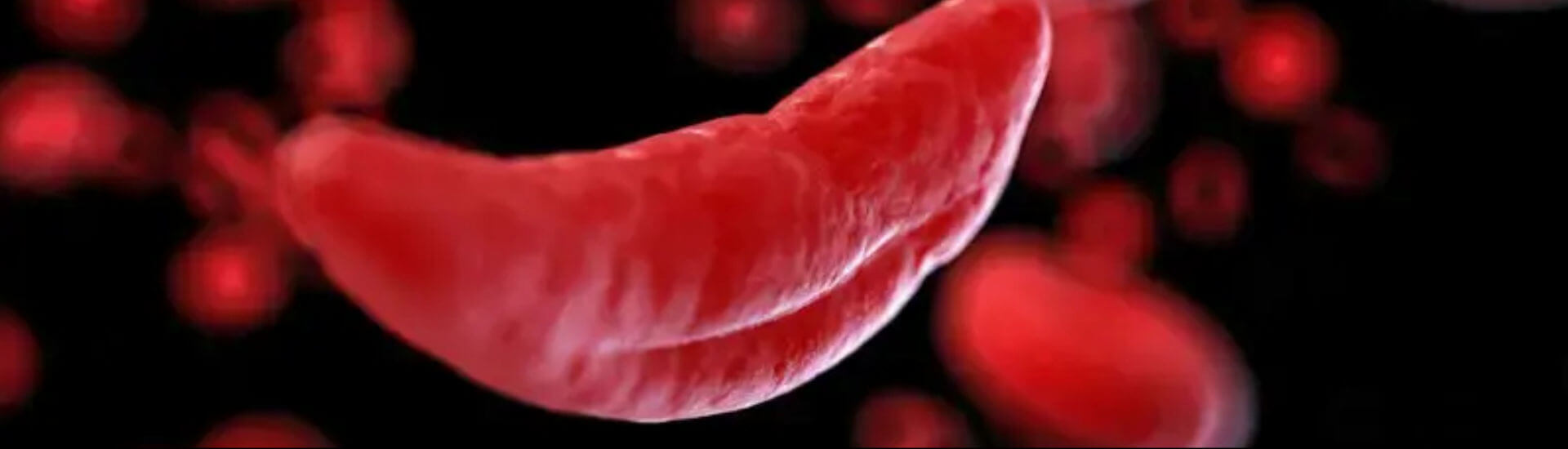 Neueinführung Oxbryta bei Sichelzellanämie - DocCheck