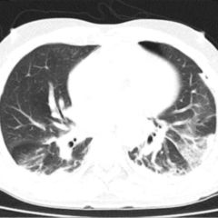 Lungenkontusion - DocCheck Flexikon