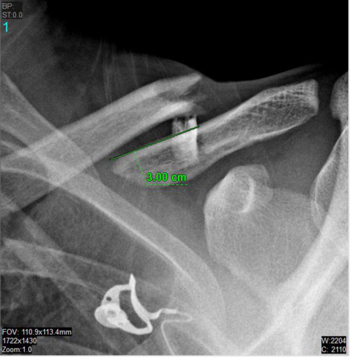 Clavicula-Fraktur - DocCheck