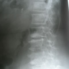 Osteophyt - DocCheck Flexikon