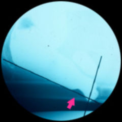 Paradoxe Diarrhö - DocCheck Flexikon