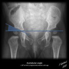 Acetabulum - DocCheck Flexikon