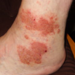 Macula - DocCheck Flexikon