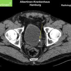 Ostium ileale - DocCheck Flexikon