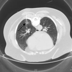 Karzinom - DocCheck Flexikon