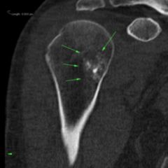 Osteochondrom - DocCheck Flexikon
