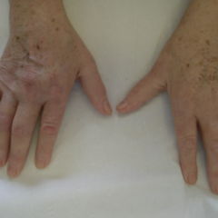 Daktylitis - DocCheck Flexikon