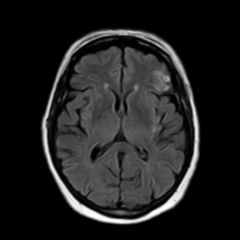 Hirninfarkt - DocCheck Flexikon
