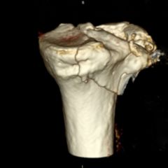 Tibiaplateau - DocCheck Flexikon