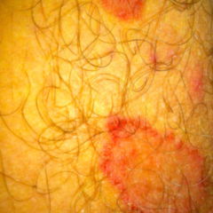 Tinea - DocCheck Flexikon