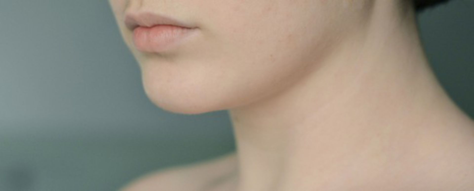 Scleredema di Buschke - DocCheck