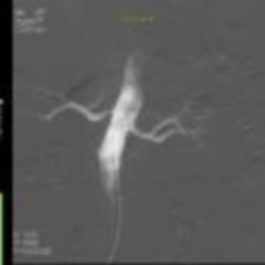 Rechtsherzinfarkt - DocCheck Flexikon