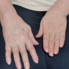 Fallhand - DocCheck Flexikon