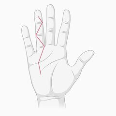 Bruner-Inzision - DocCheck Flexikon