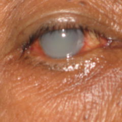 Colpitis senilis - DocCheck Flexikon