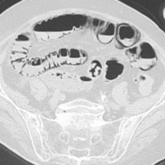 Truncus intestinalis - DocCheck Flexikon