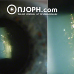 Kongenitale Katarakt - DocCheck Flexikon